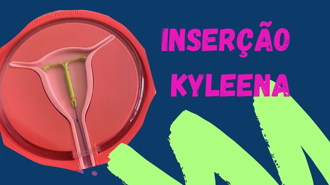 Inserção DIU Kyleena - YouTube