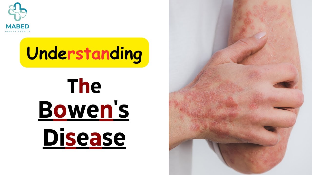 Bowen's Disease Causes, Effects, Symptoms, Treatments, and Ayurvedic ...