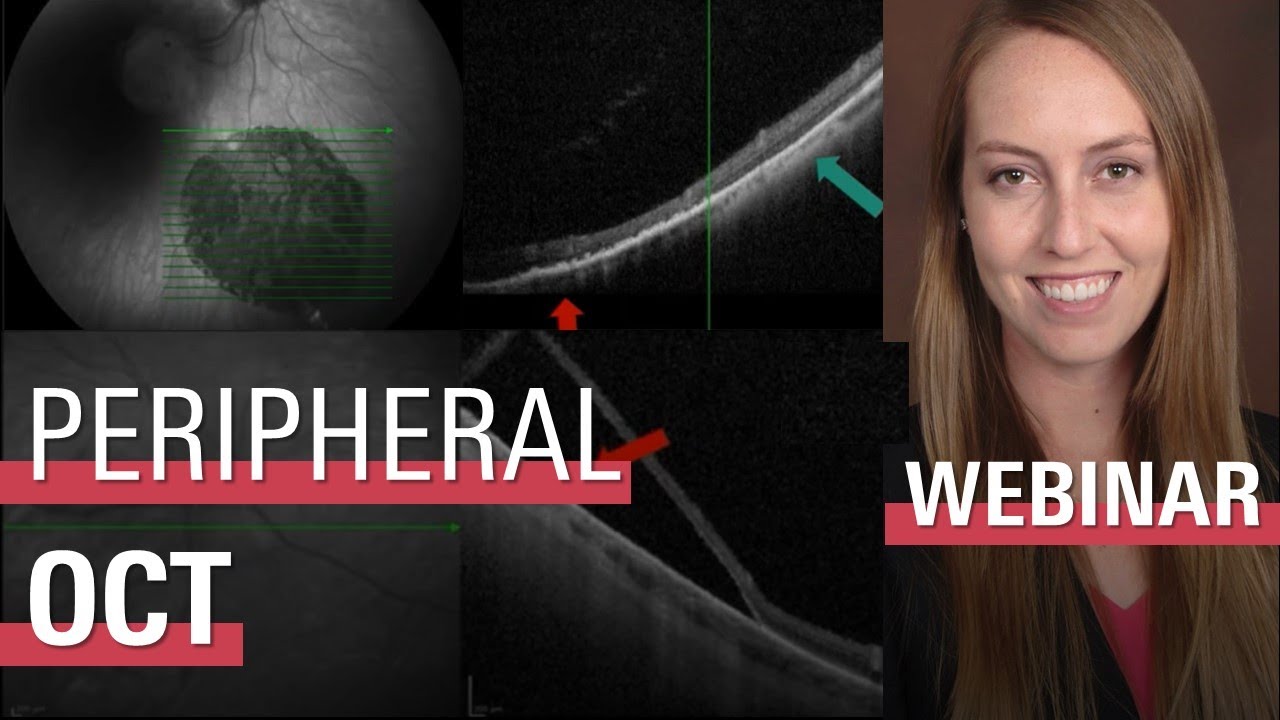 Taking OCT to the Edge: Evaluating the Peripheral Retina with OCT - YouTube