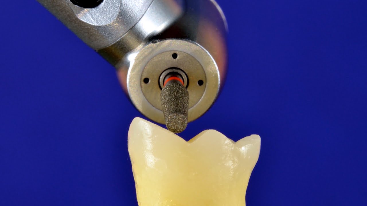 Posterior crown by Vprep technique PAG : La couronne V-Prep / Atlas ...