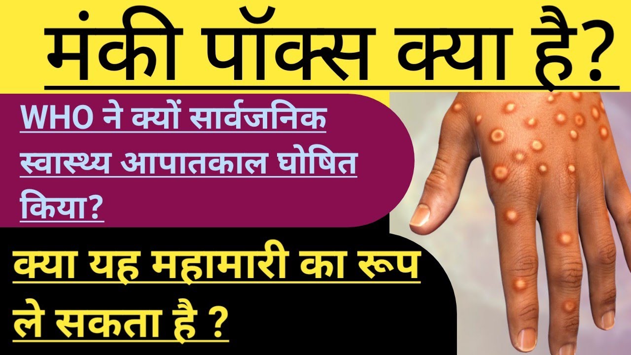 what is monkeypox virus/ monkeypox outbreak/monkeypox virus/ monkeypox/ monkey virus news / ️ ️👌 ...