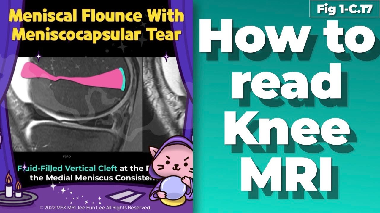 (Fig 1-C.17) Meniscal Flounce with meniscocapsular tear - YouTube
