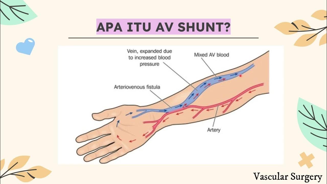 apa itu AV shunt - YouTube