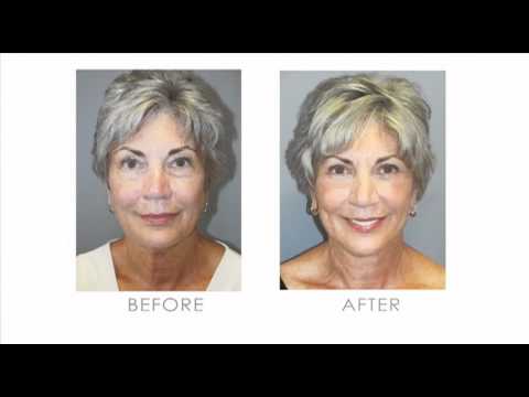 Orange County Quick Facelift Before and After - The LiteLift™ - YouTube