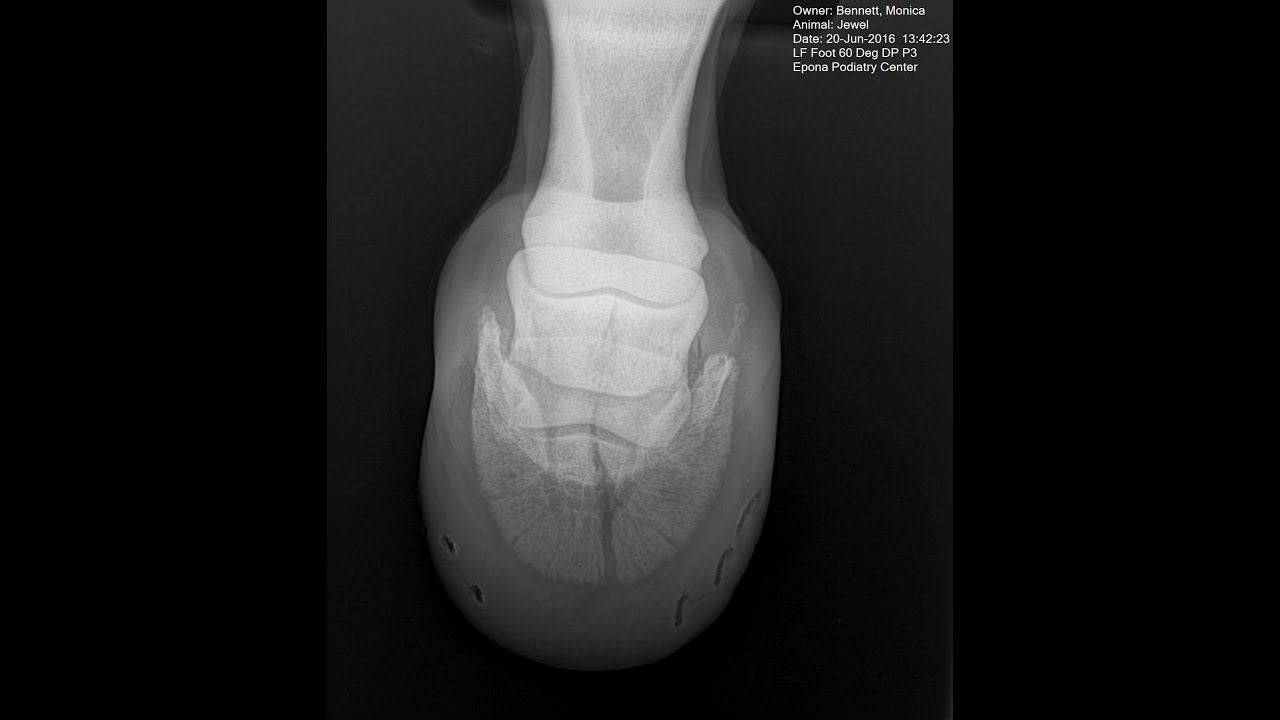 Long-Term Case Study of a Fractured Pedal Bone - YouTube