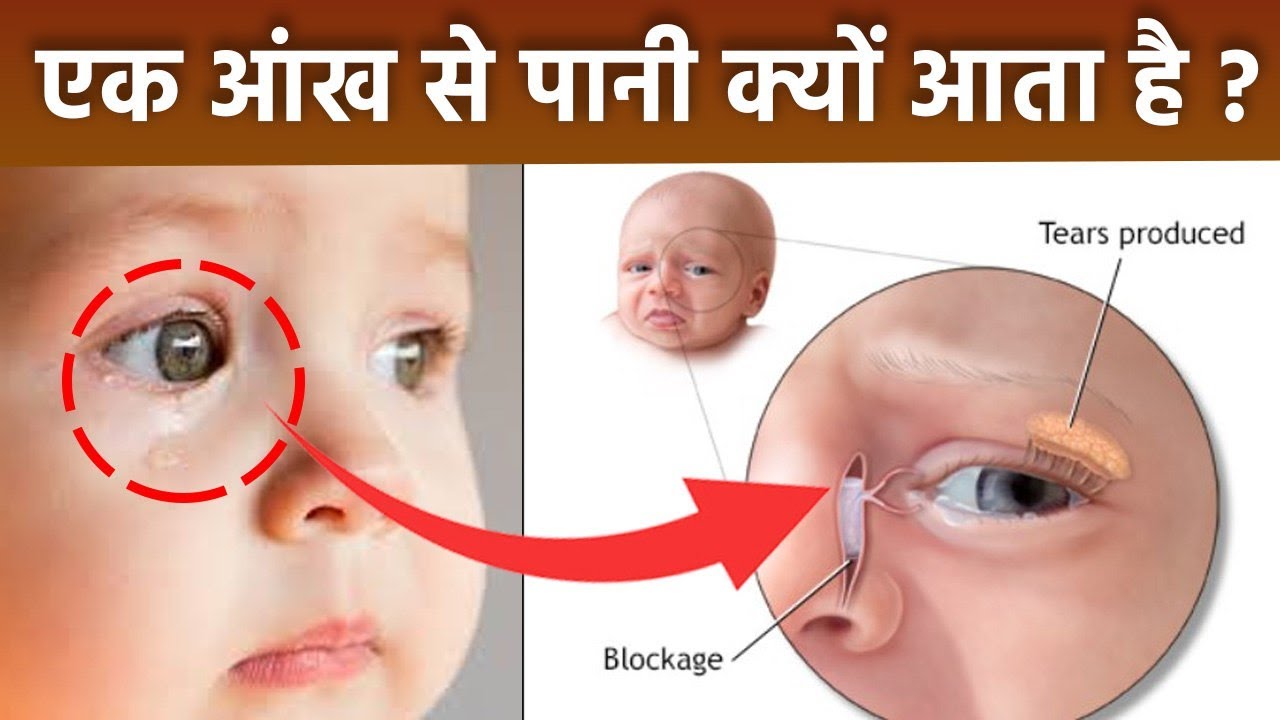 Baby One Eye Watering Reason In Hindi, Treatment क्या है|बच्चे के 1 आंख ...