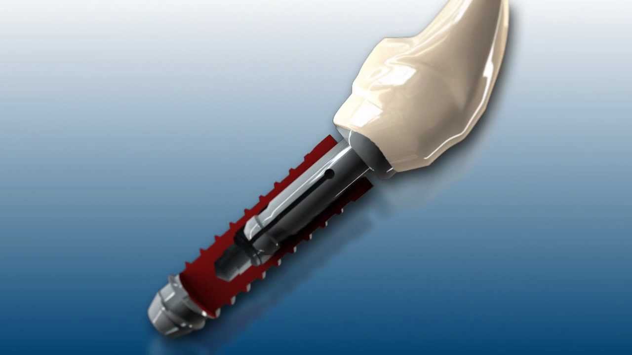 ATOLL Implant.wmv - YouTube