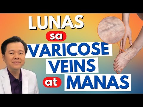 Lunas sa Varicose Veins at Manas. - By Doc Willie Ong (Internist and Cardiologist) - YouTube