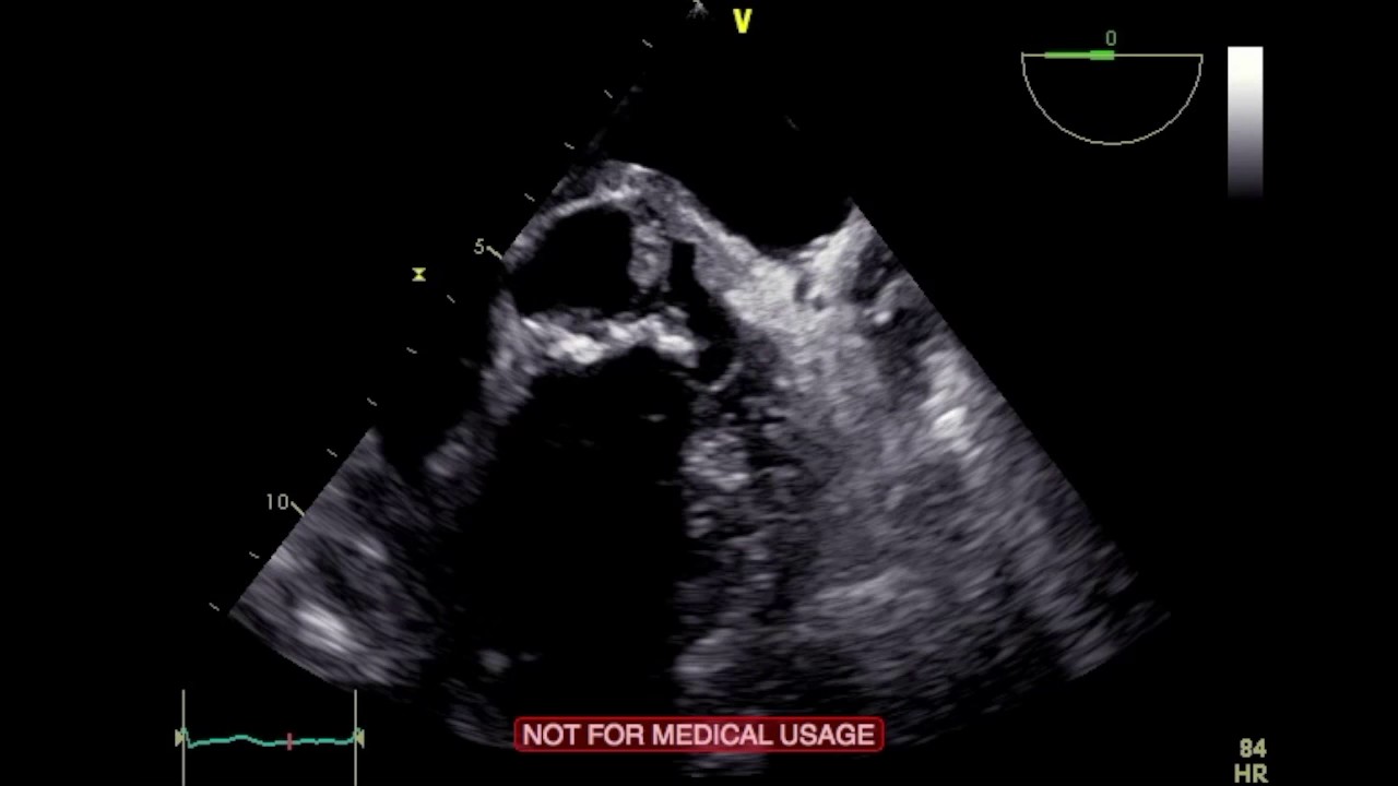 TOE Endocarditis - YouTube