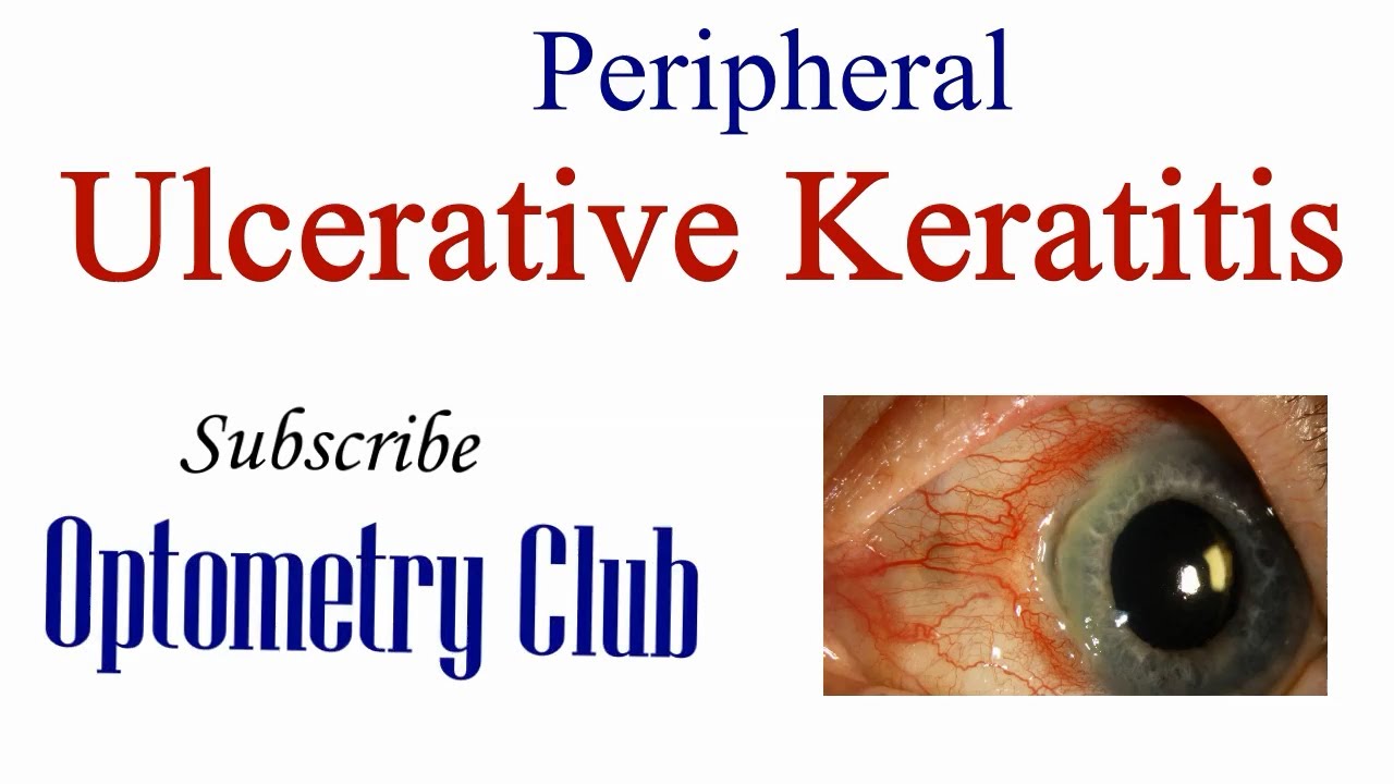 Peripheral Ulcerative Keratitis Introduction, Systemic Symptoms ...