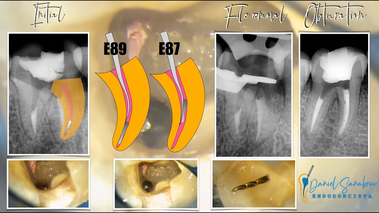 New Terauchi Removal Kit / Broken file removal OD 4.7 / Woodpecker ...