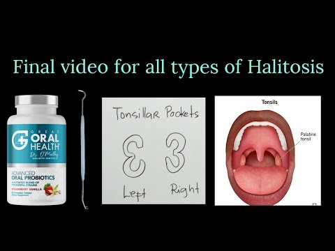 Final solution for all types of halitosis, tonsil stones, and dysbiosis ...