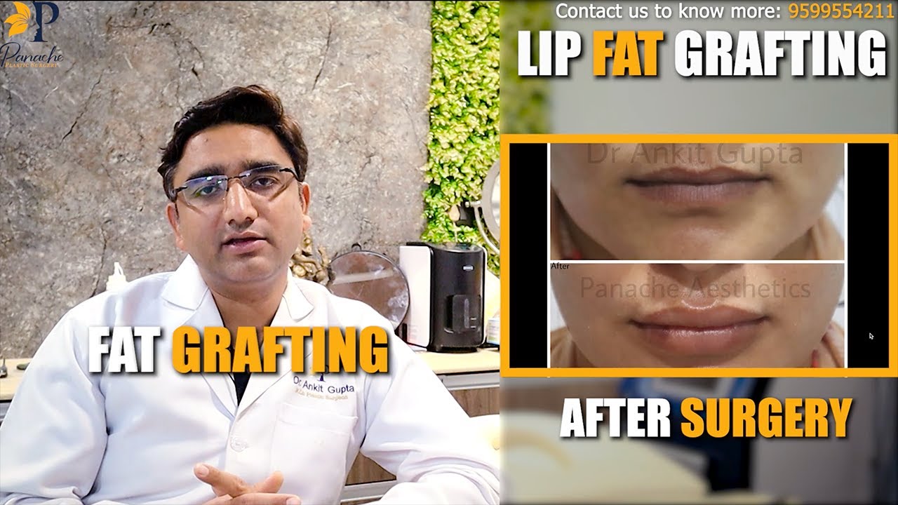 Lip Augmentation by Fat | Lip Fat Grafting | Fat Grafting for Lips! # ...