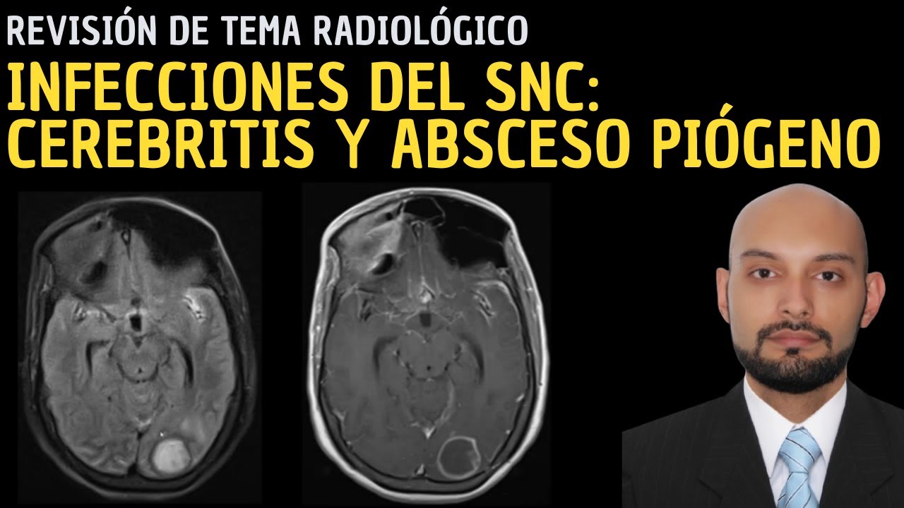Revisión de Tema 81: Infecciones del sistema nervioso central ...