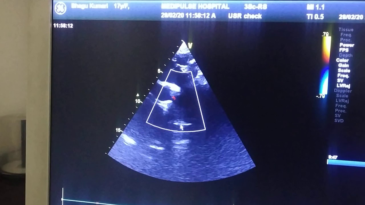 Full protocol of echo...... - YouTube