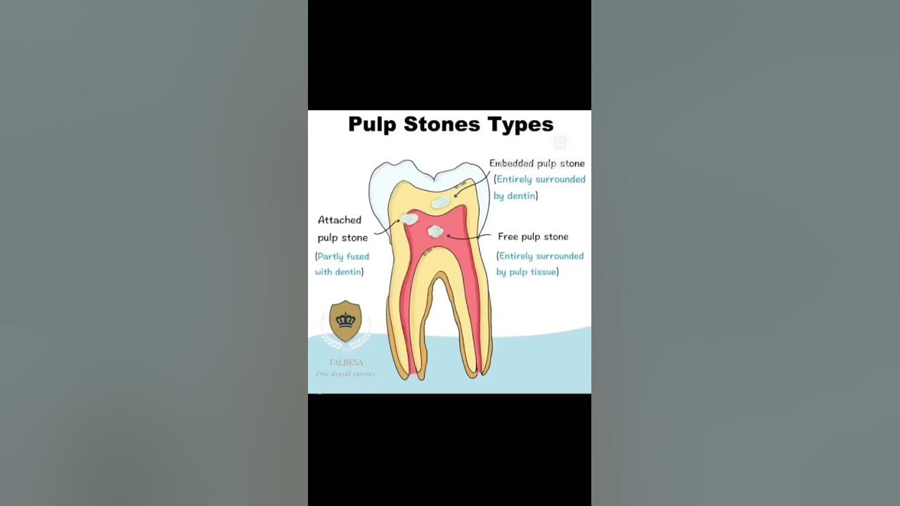 Pulp stones types | subscribe for more - YouTube