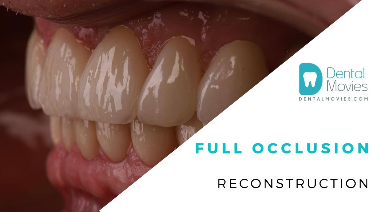 Full occlusion reconstruction - YouTube