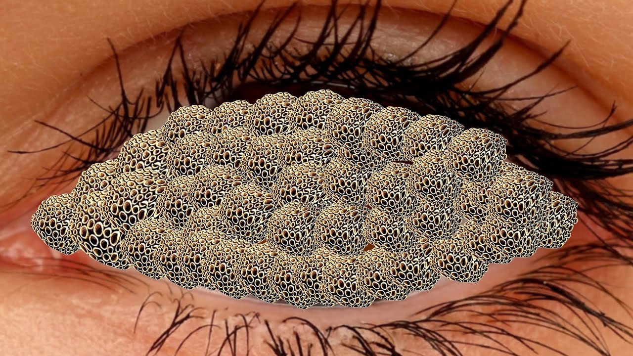 Eye treatment animation | severaly loosing eye | treatment animation ...