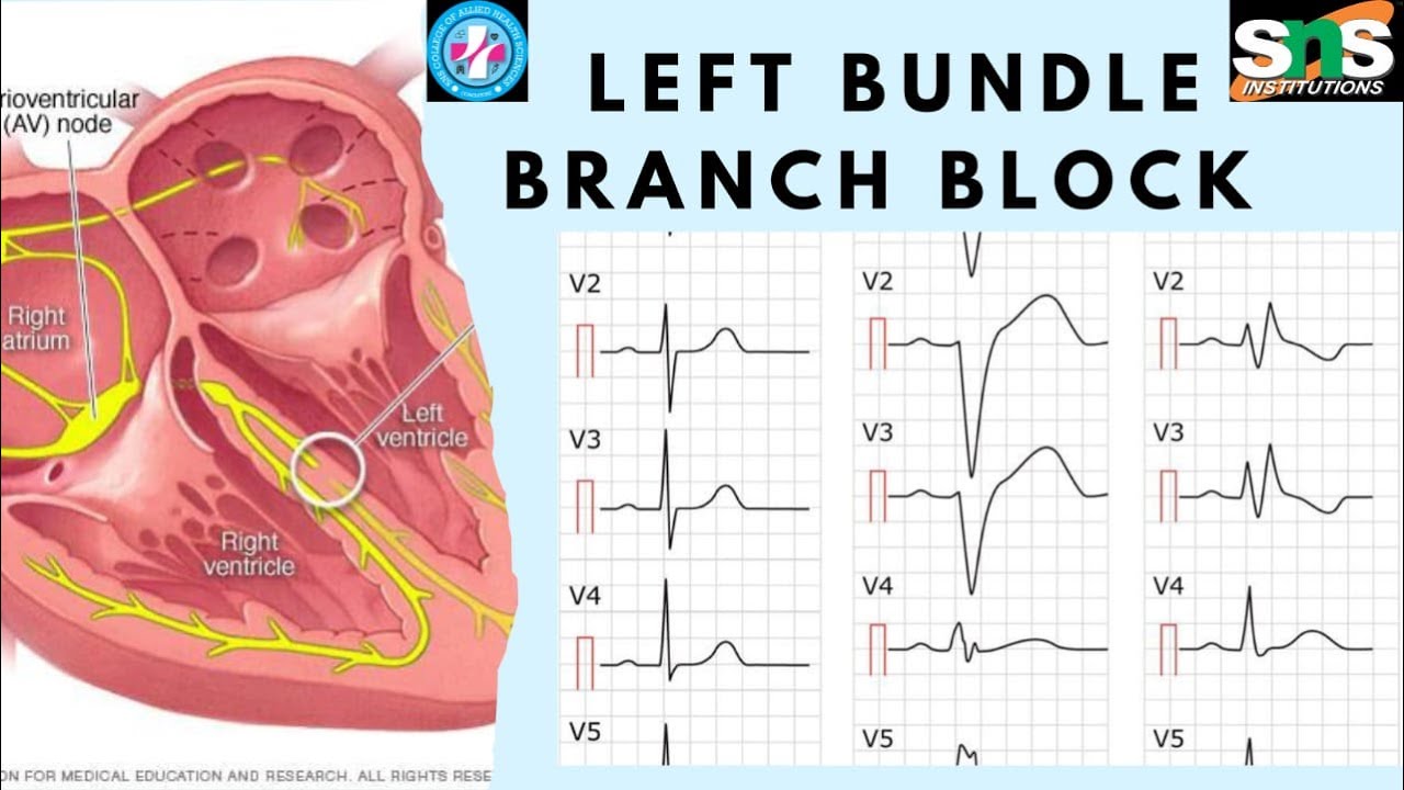 Left Bundle Branch Block - YouTube