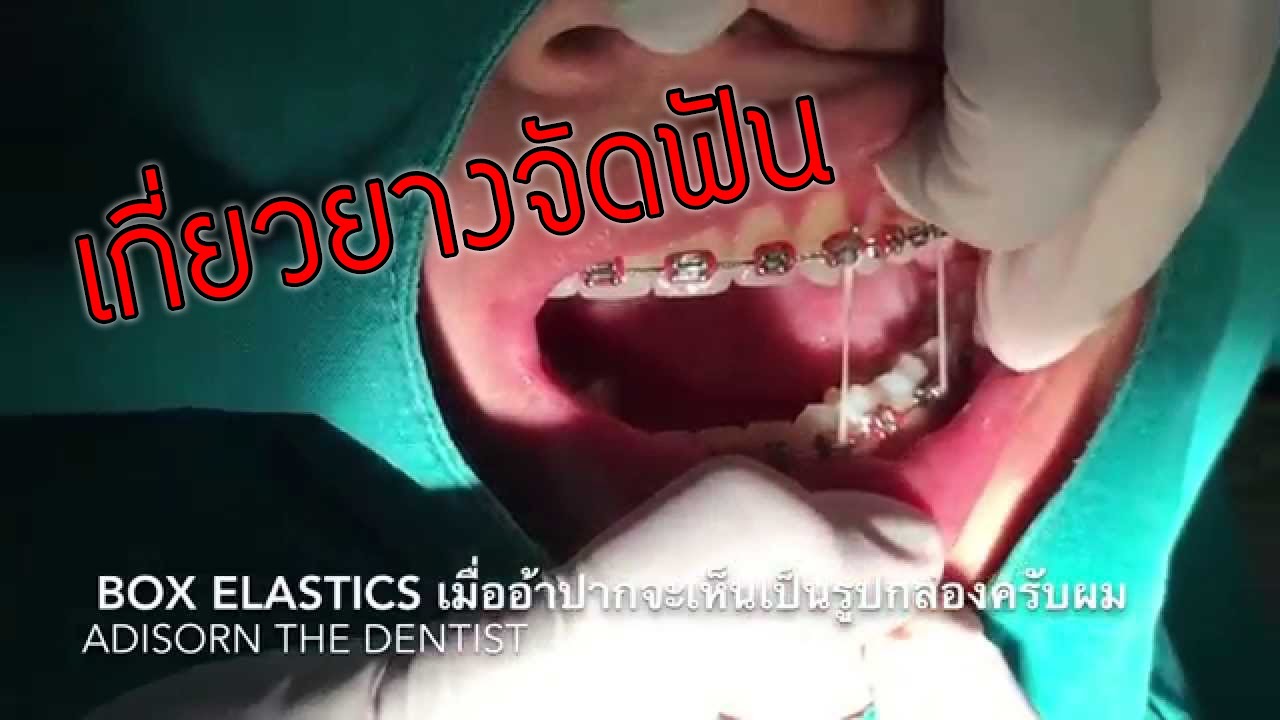 Ep.14 การเกี่ยวยางอีลาสติกแบบ Posterior Box Elastics - YouTube