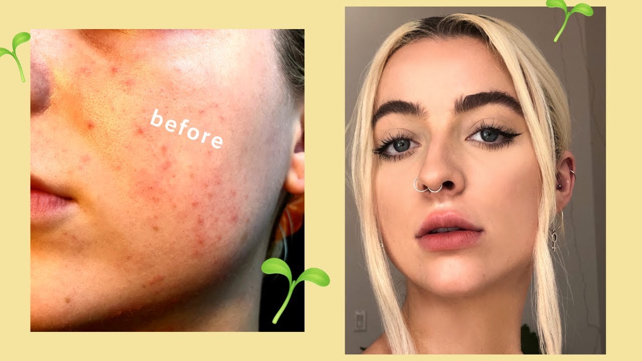 Skincare Routine How I Cleared My Acne Prone Skin Cruelty Free