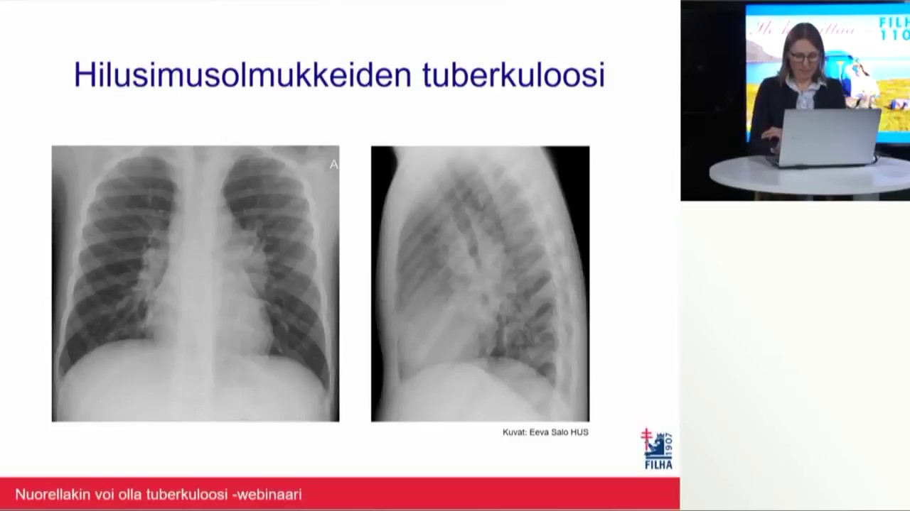 Tuberkuloosi – mitä se on? - YouTube