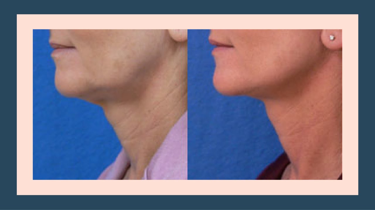 What is a Wattle? - YouTube