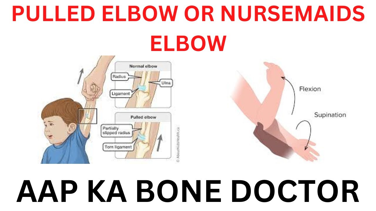 PULLED ELBOW OR NURSEMAID'S ELBOW - EPISODE 65 - YouTube