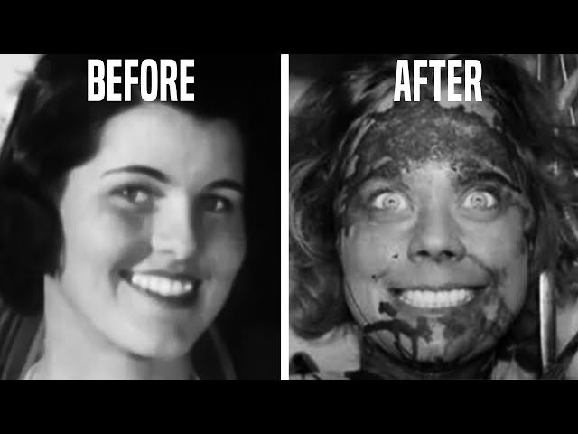 Lobotomy Before And After