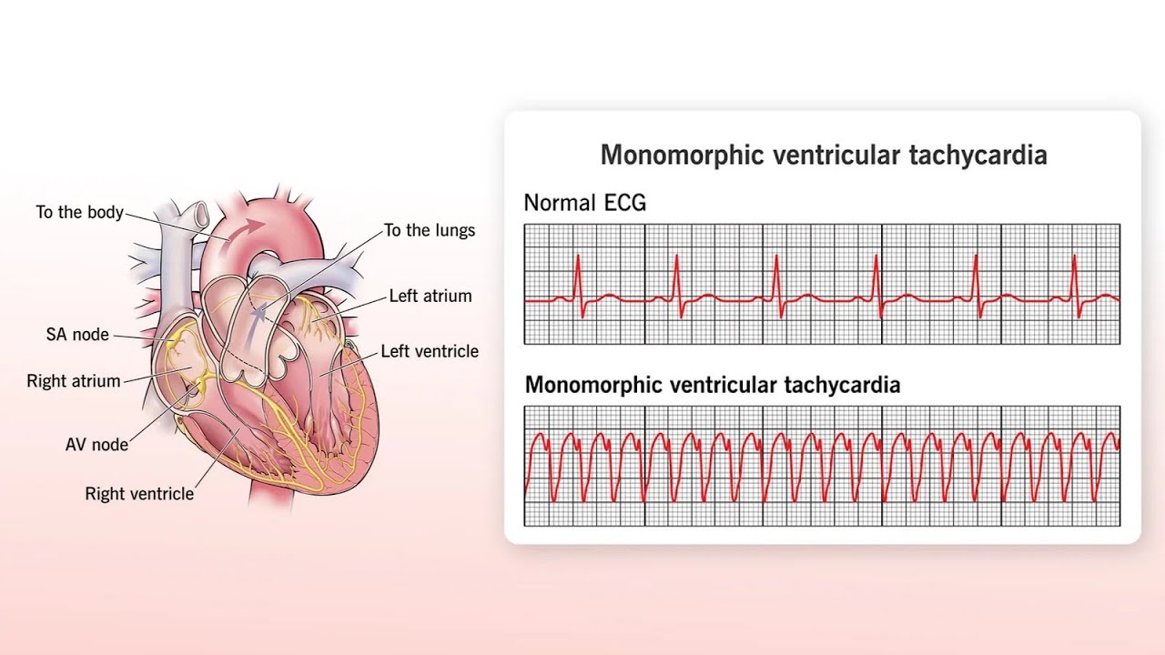 Monomorphic Ventricular Tachycardia ; Definition, Causes, Symptoms ...