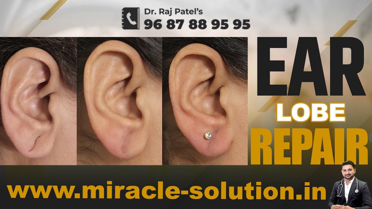 Ear Lobe Remedy Non Surgical Earlobe Repair Treatment, Ear lobe repair ...