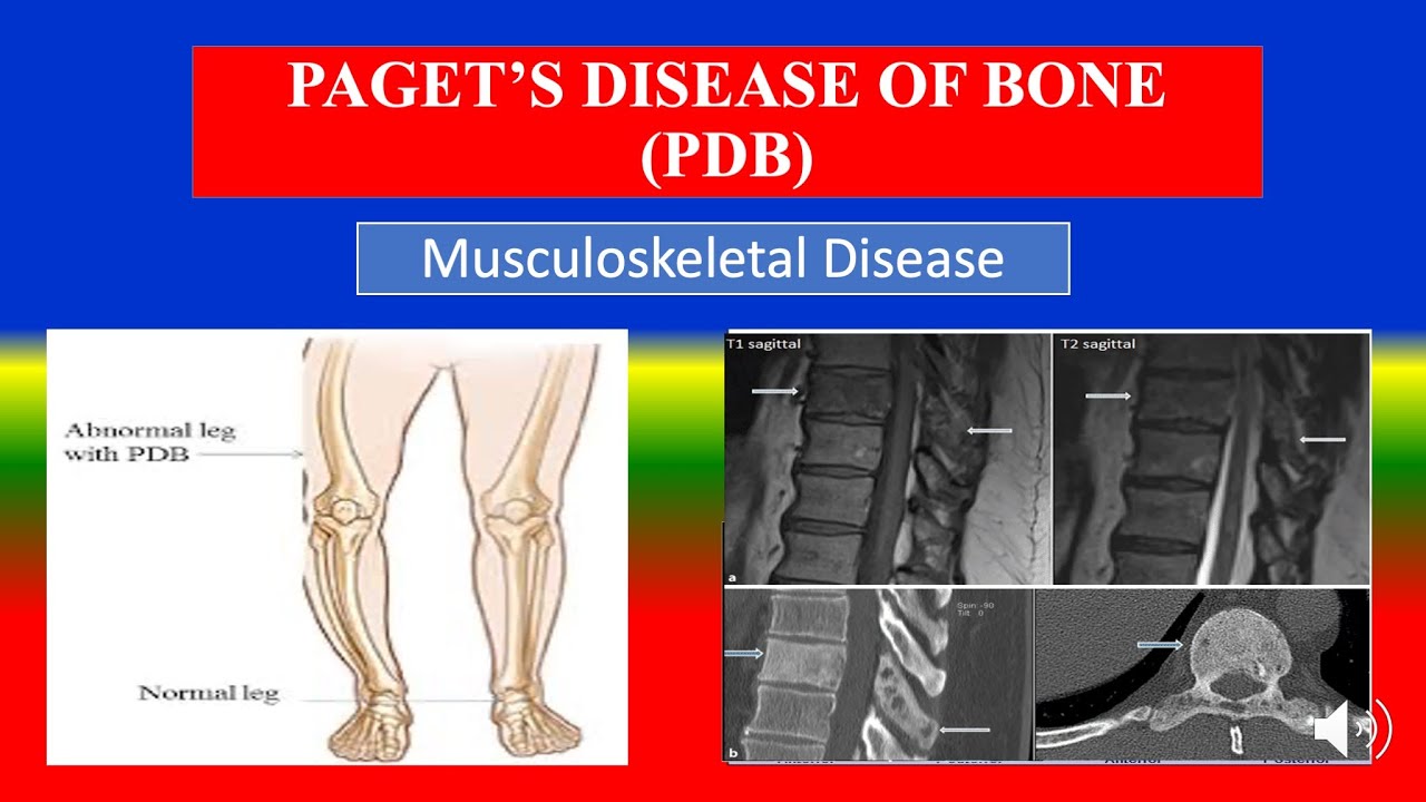 PAGET’S DISEASE OF BONE (PDB) - Definition, types, causes ...