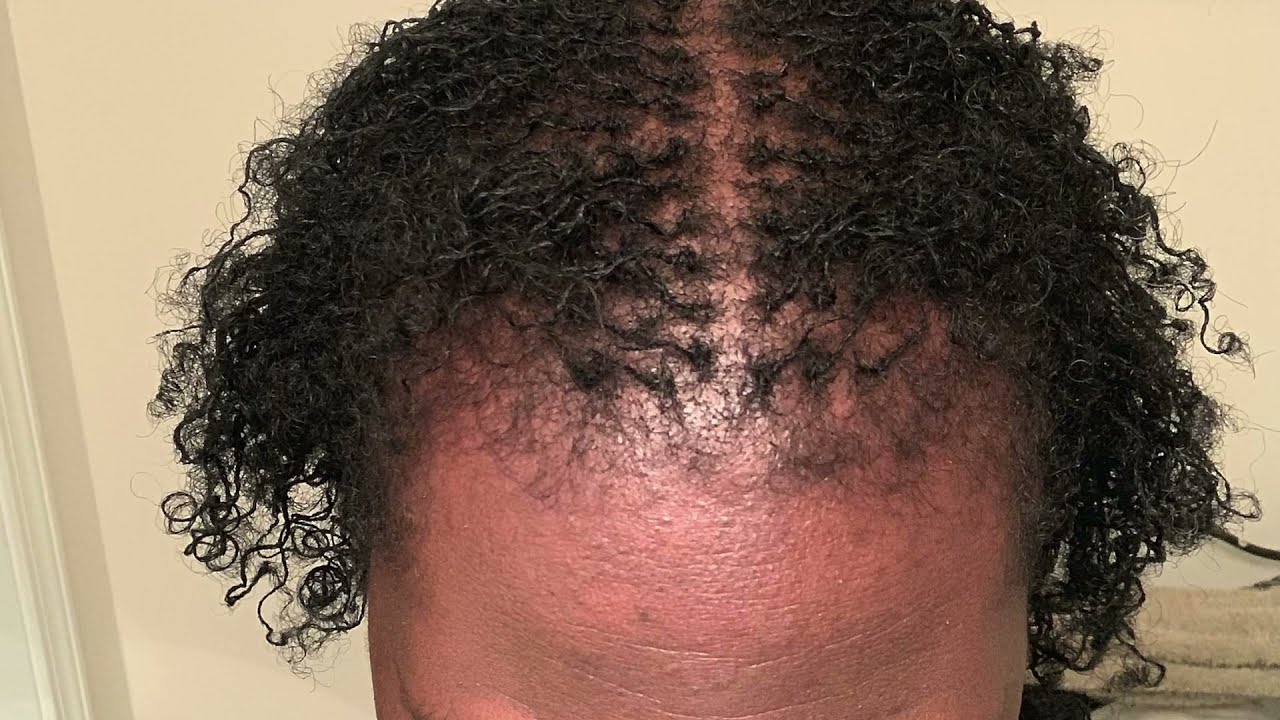 23 month Sisterlocks© Hair Growth Timelapse on Fine Thin Hair Low ...