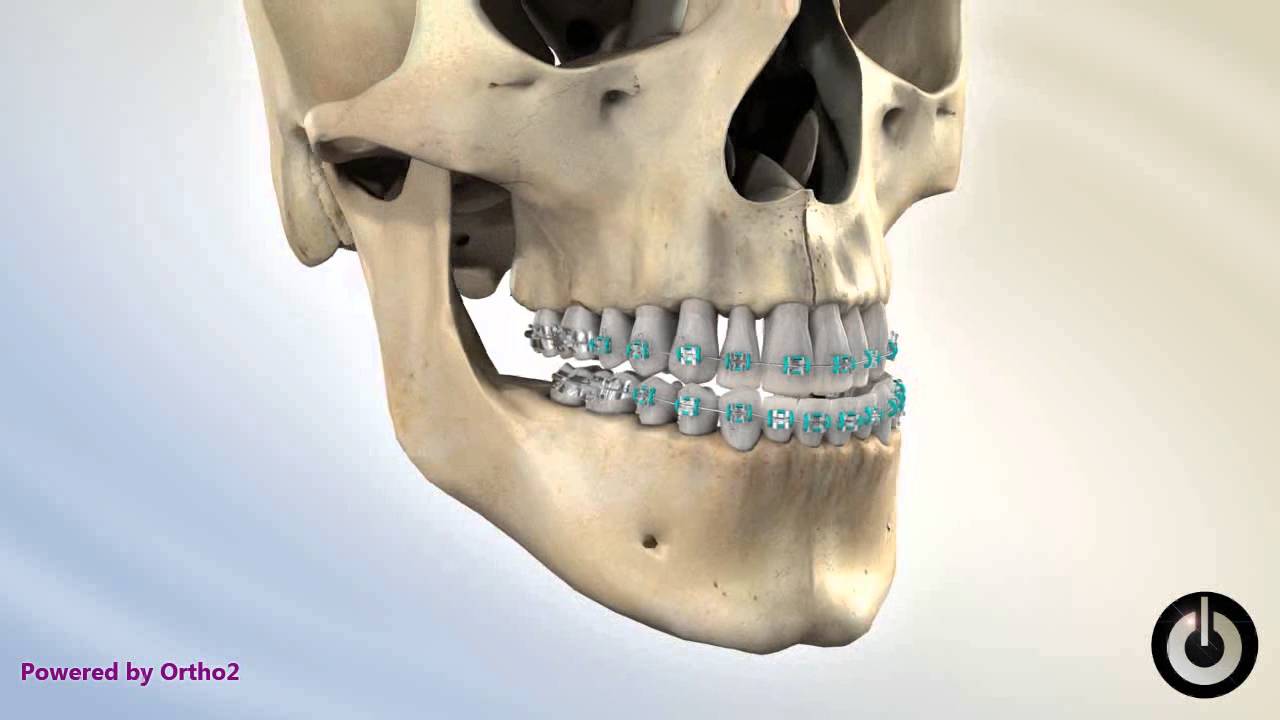 BSSO - Jaw Surgery - YouTube