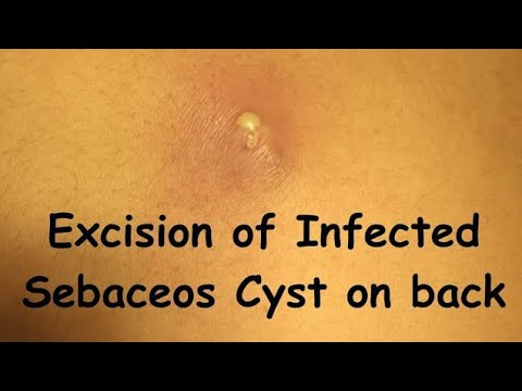 Drainage & Excision of Infected Sebaceous Cyst | Back Cyst Removal ...