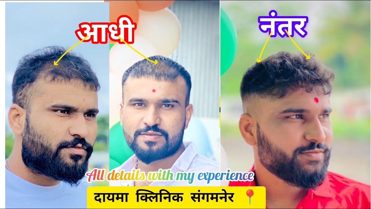 Dayma clinic Sangmner best solution for hair regrowth 💯|| जेवढे गेलेत ...