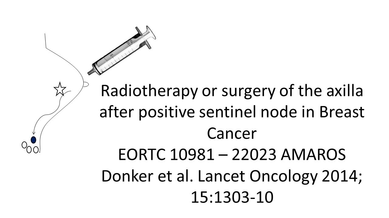 Radiation to Lymph nodes versus axillary dissection after positive SLNB ...