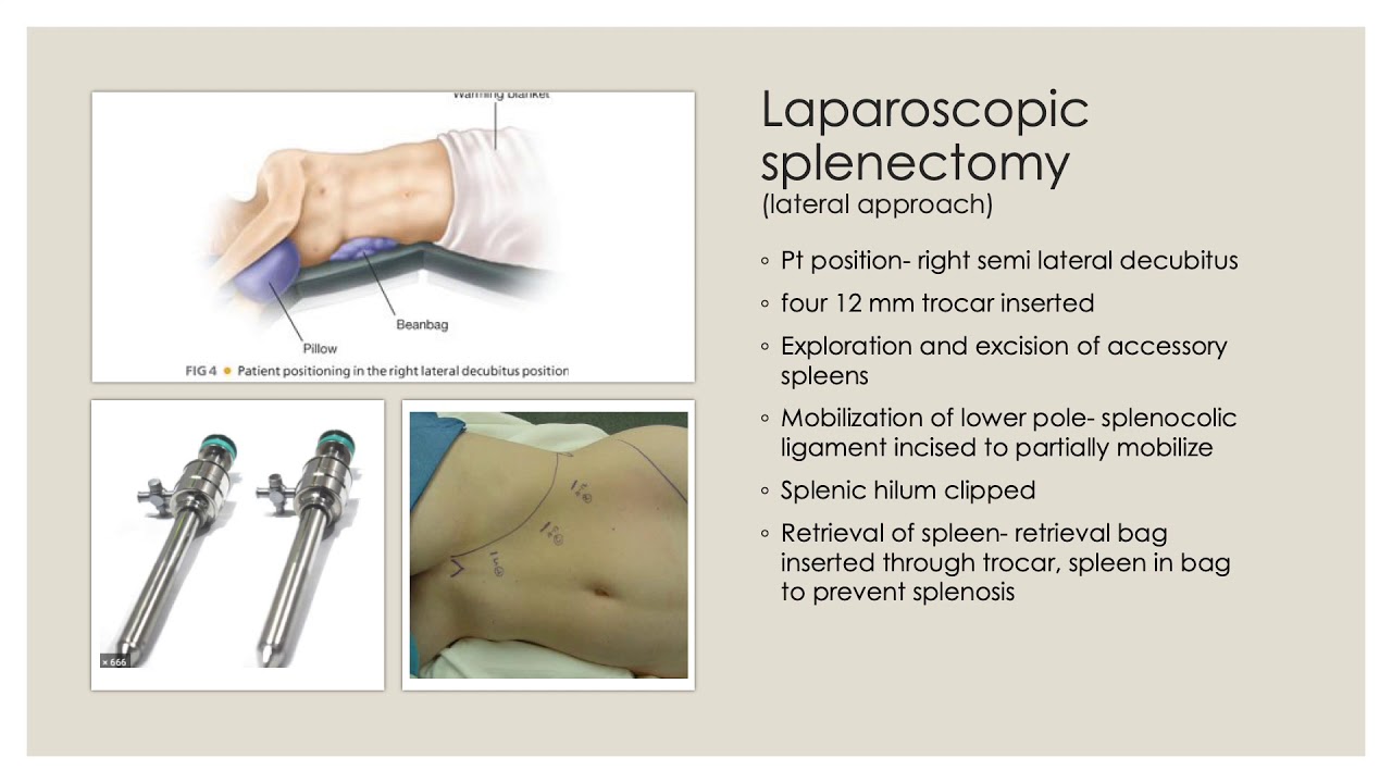 Splenectomy Specialty Presentation - YouTube