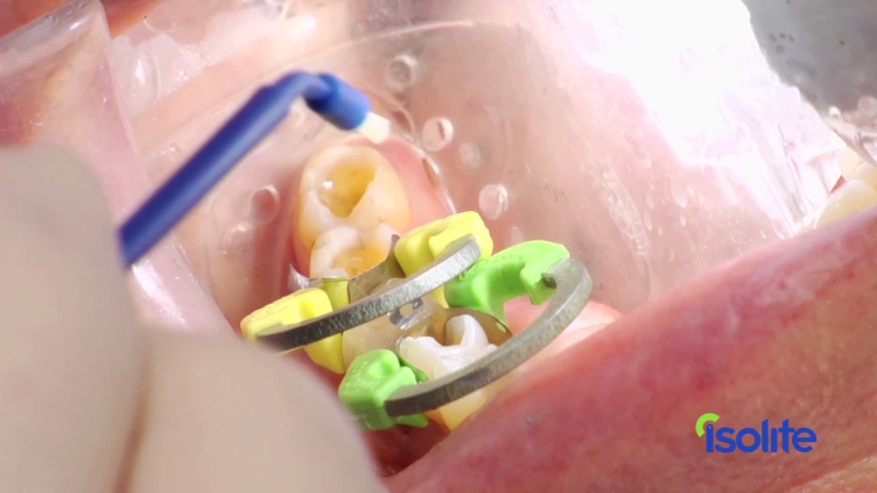 Isolite Systems and Fillings - YouTube