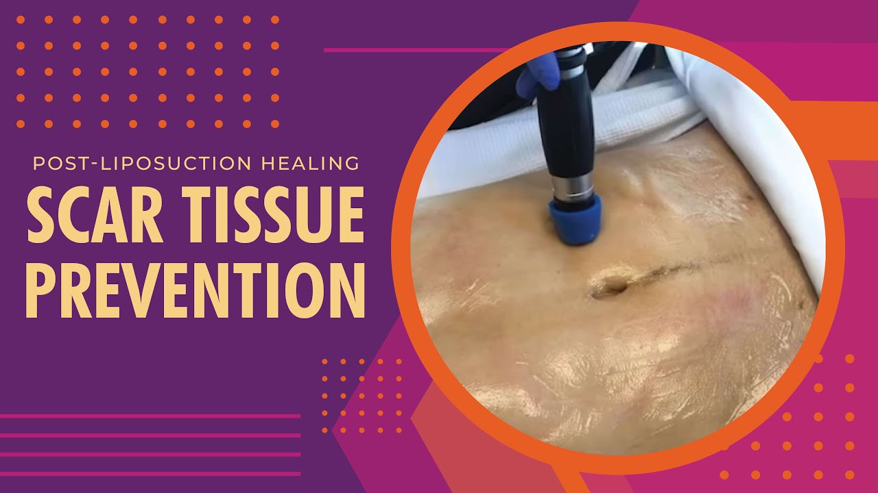 Post-Liposuction Healing | Scar Tissue Prevention | West Hollywood, CA ...