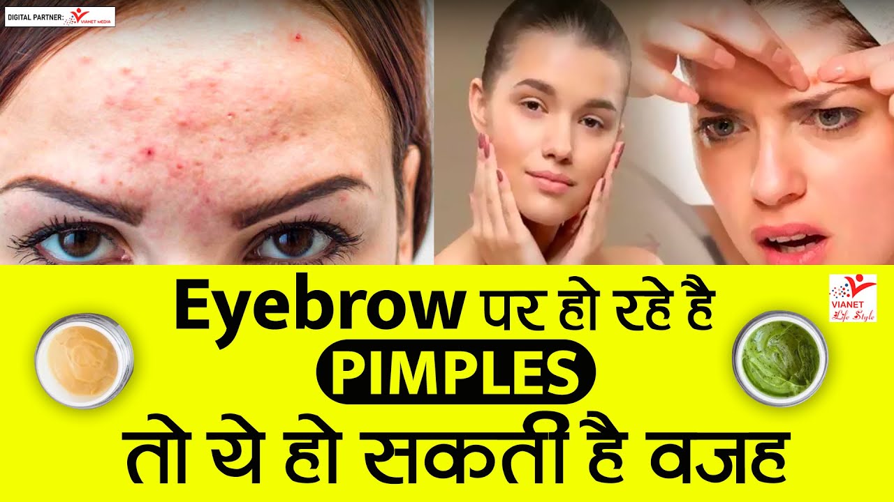 Pimples Around Eyebrows