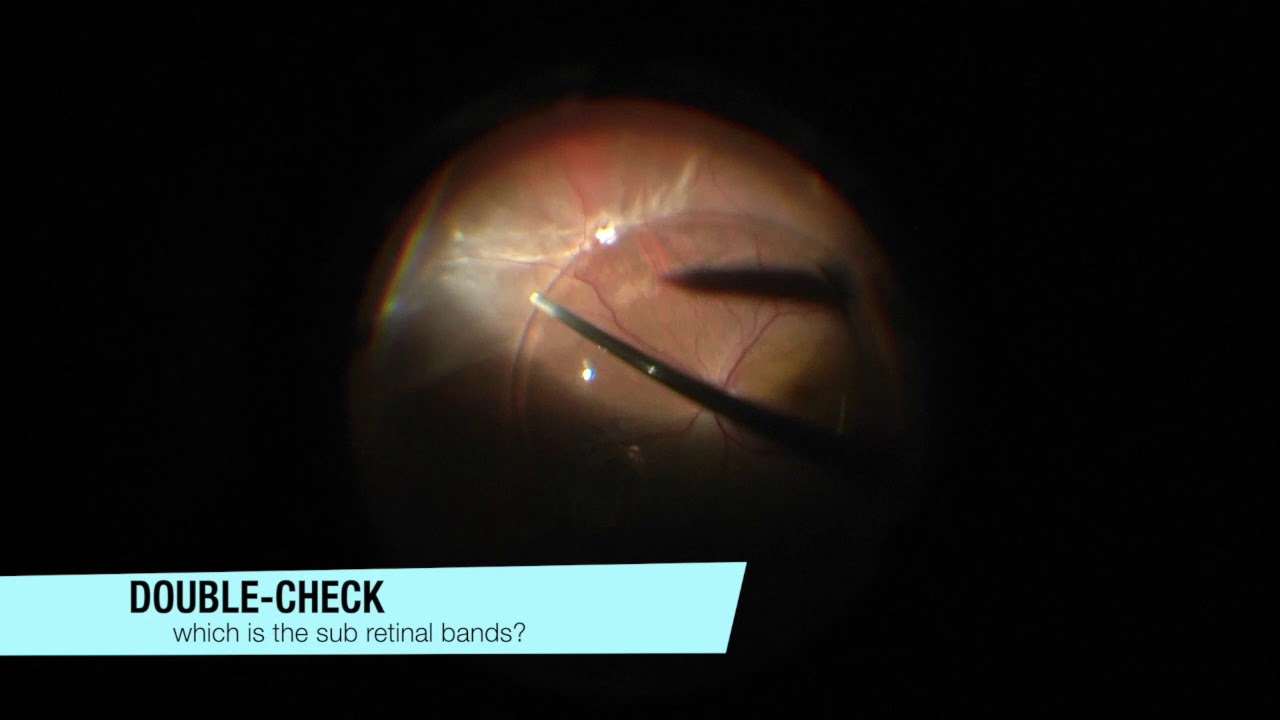 Retinal detachment - PVR, subretinal bands removal - YouTube