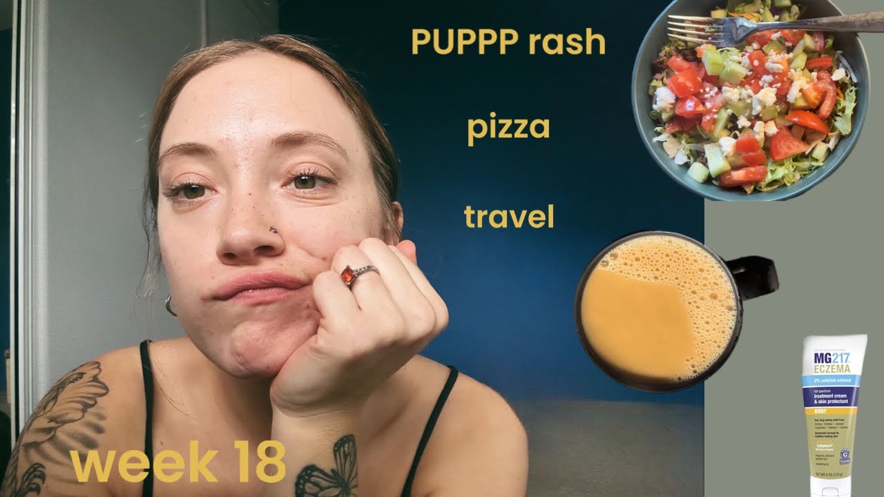 pregnancy diaries: week 18 / dealing with PUPPP rash - YouTube