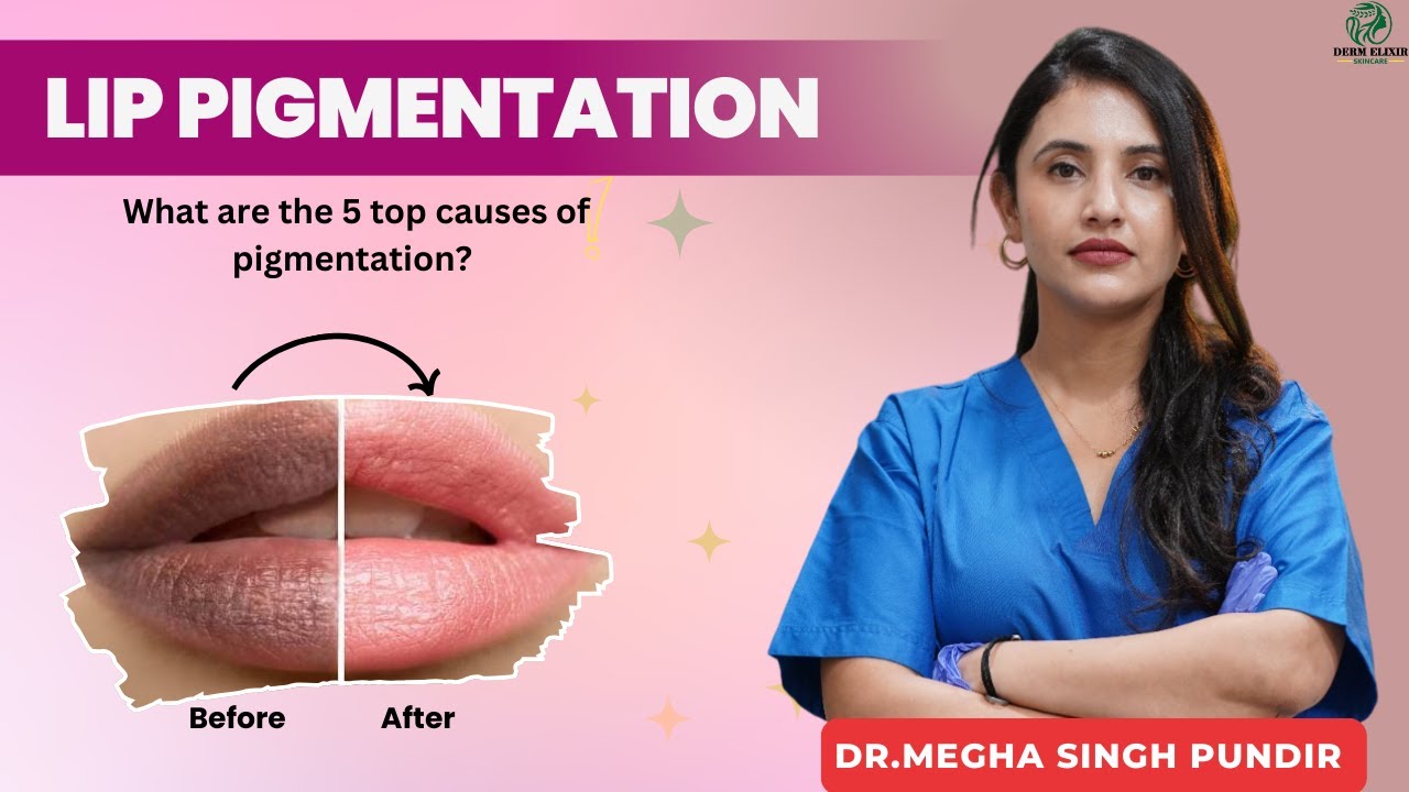 Treatment for Lip Pigmentation | Dark lips treatment | How to lighten ...