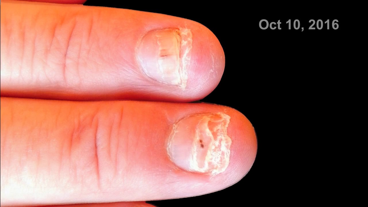 Fingernail growth time lapse - YouTube