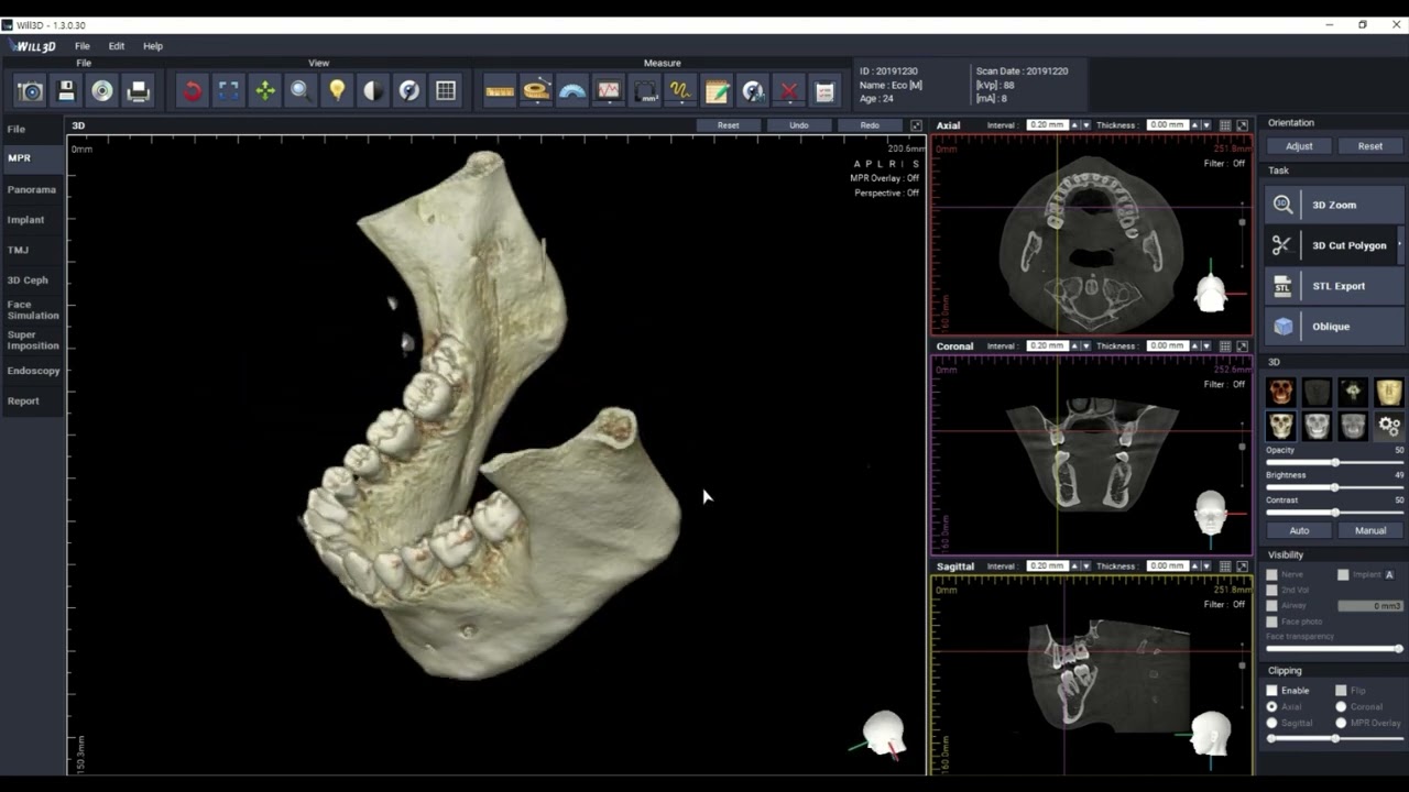 2. Will3D MPR 3D Tool - YouTube
