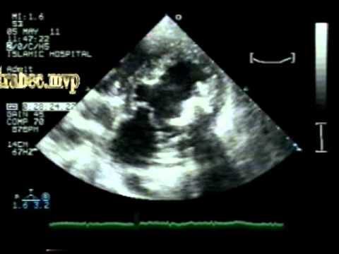 Tiger heart:a variant of LV noncompaction? - YouTube