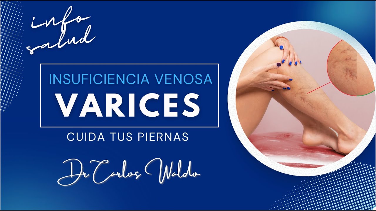 INSUFICIENCIA VENOSA VARICES cuida tus piernas - YouTube