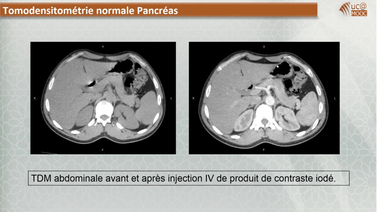 FMPM MOOCs - Radiologie digestive, Imagerie du pancréas - Pr. N. Cherif ...