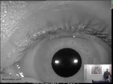 Right Posterior Canalithiasis and Right Horizontal Cupulolithiasis ...